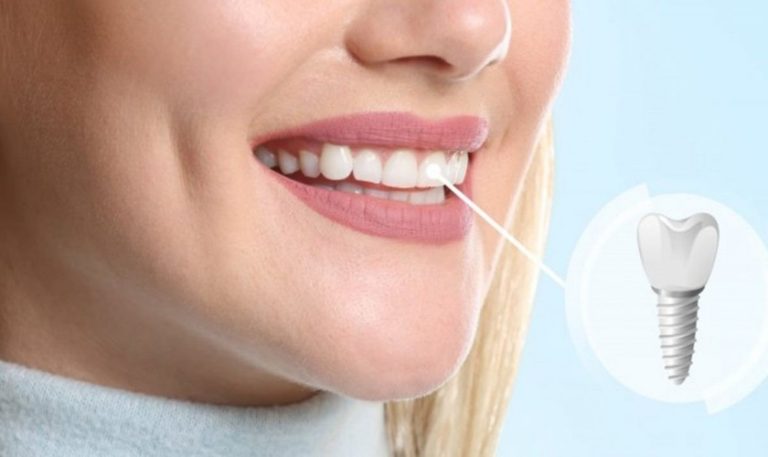 Implant SIC và những điều cần biết - Implantcenter.vn