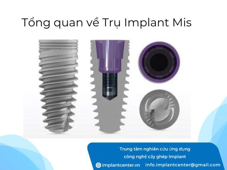 Trụ Implant Mis: phân loại, nguồn gốc, cấu tạo và giá cấy răng Implant Mis