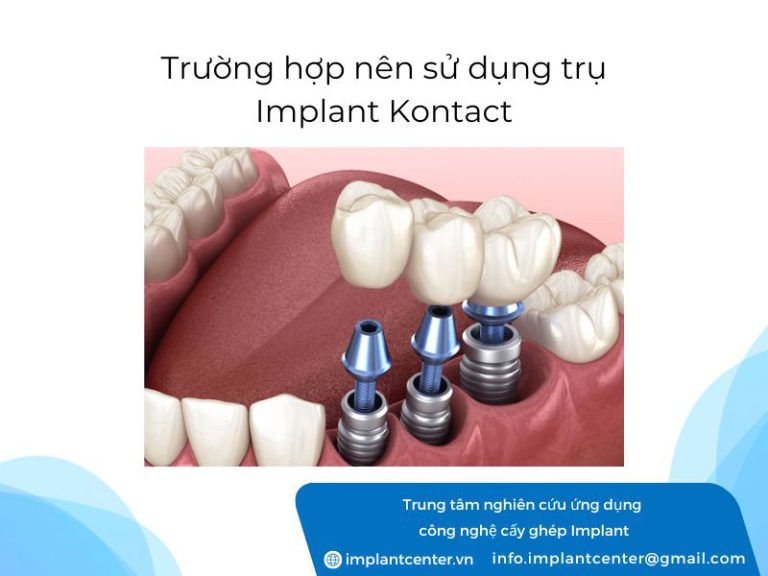 Trụ Implant Kontact Biotech: Xuất xứ, Cấu tạo và Chi phí