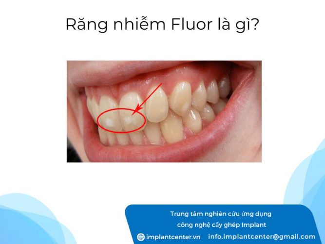 Răng nhiễm Fluor là gì? 4 nguyên nhân dẫn đến răng nhiễm Fluor